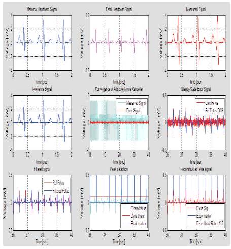 Figure 5. Fetal ECG Extraction simulation Results