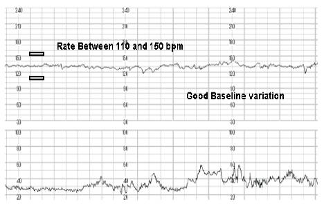 Fig. 1: CTG Trace of a normal unborn